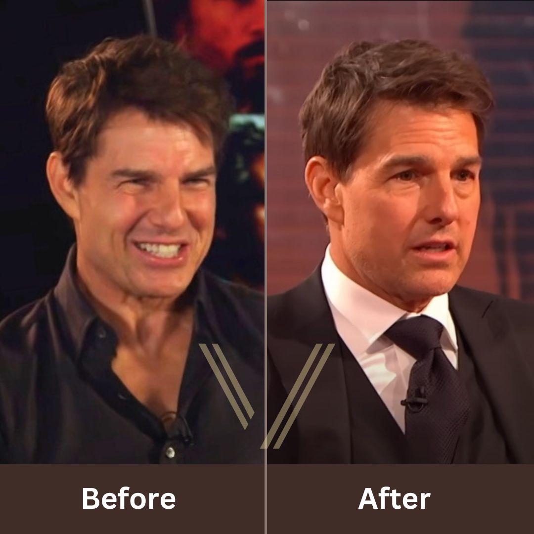 Tom Cruise Hair Transplant: Before and After Transformation