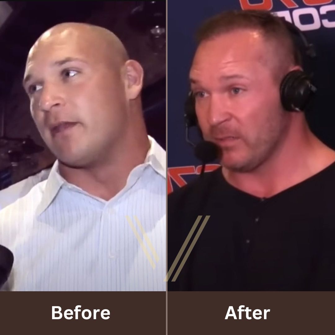 Brian Urlacher Hair Transplant
