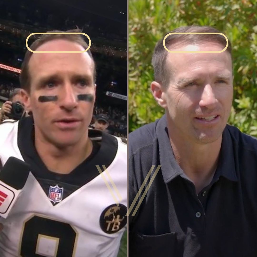 Drew Brees Hair Transplant