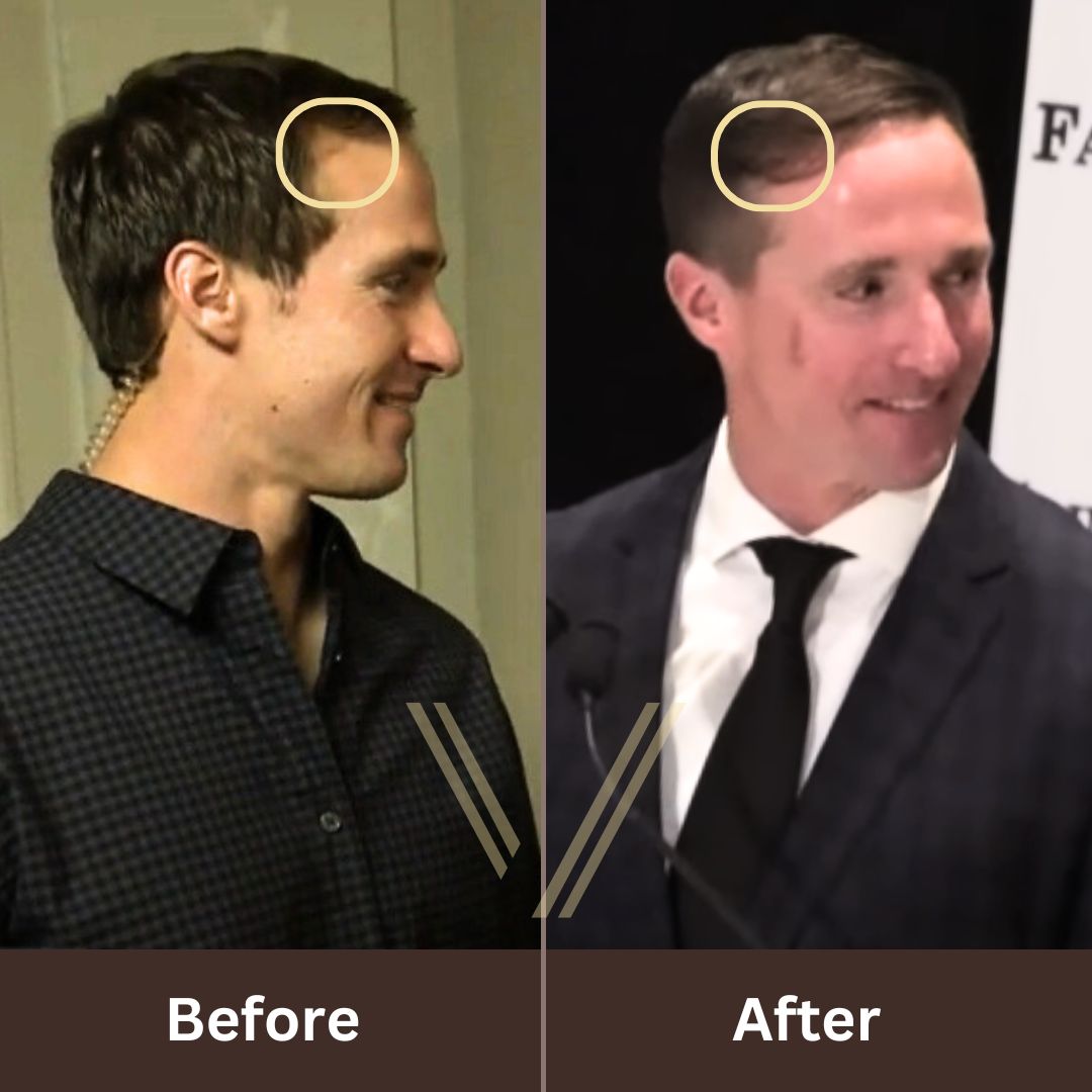 Drew Brees Hair Transplant