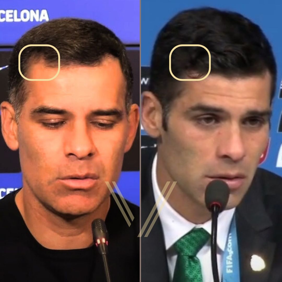 Rafa Marquez Hair Transplant