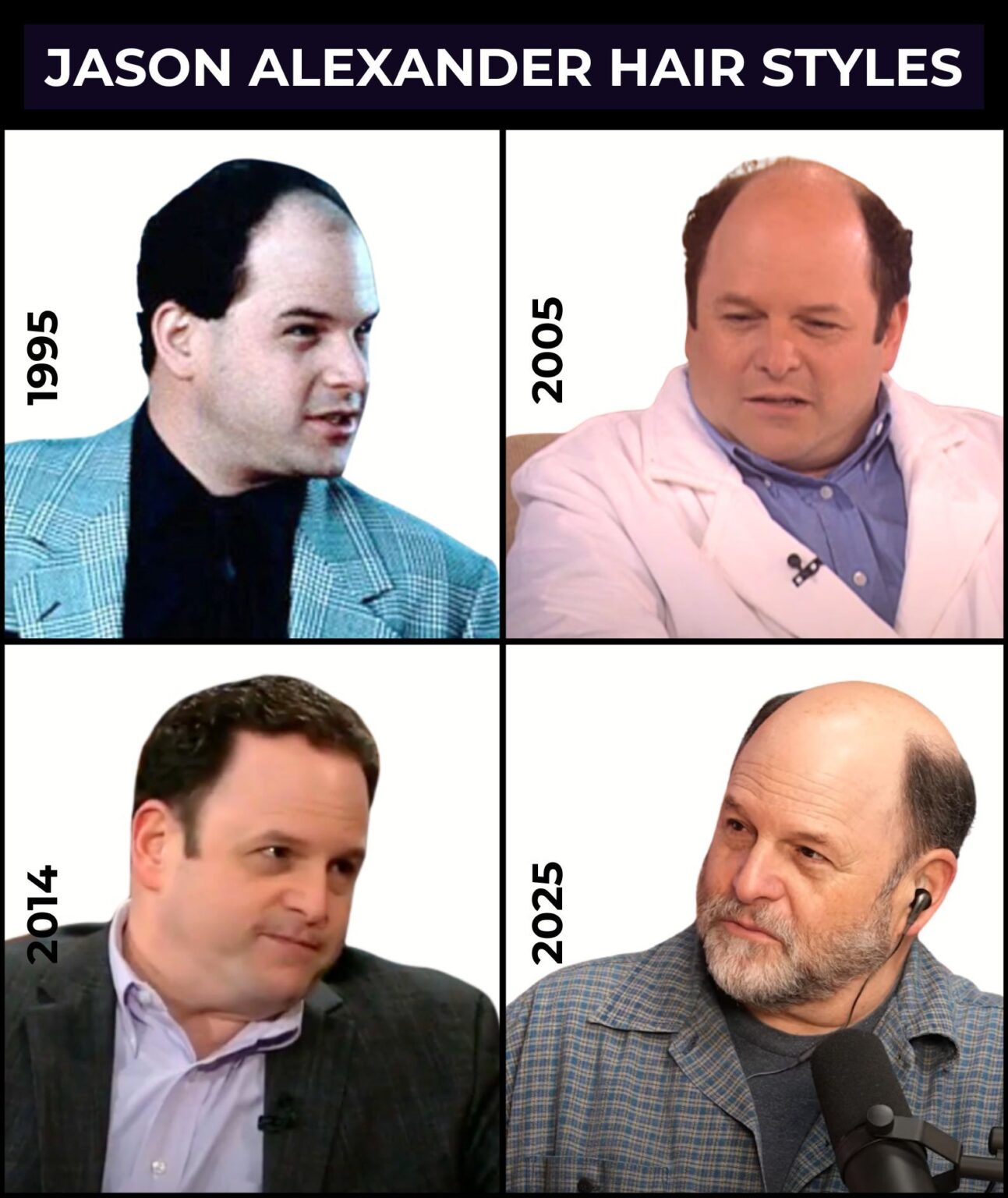 Jason Alexander Hair Transplant - Before and After