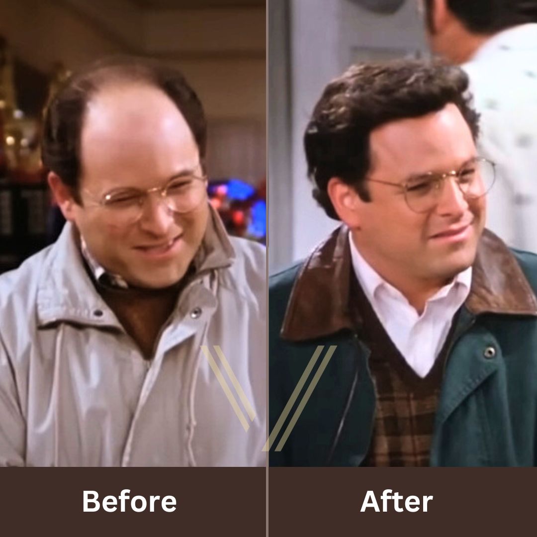 Jason Alexander Hair Transplant - Before and After