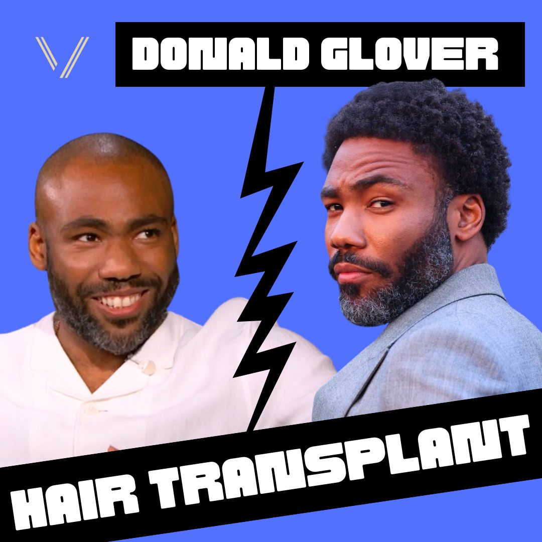 Donald Glover Hair Transplant - Before and After