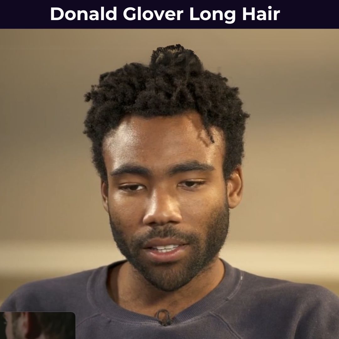 Donald Glover Hair Transplant - Before and After