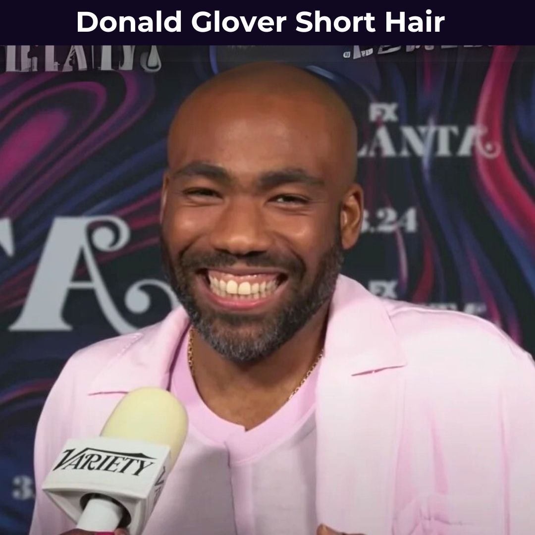 Donald Glover Hair Transplant - Before and After