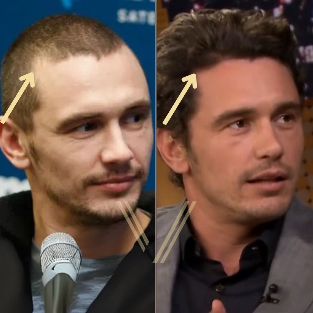 James Franco Hair Transplant - Before and After