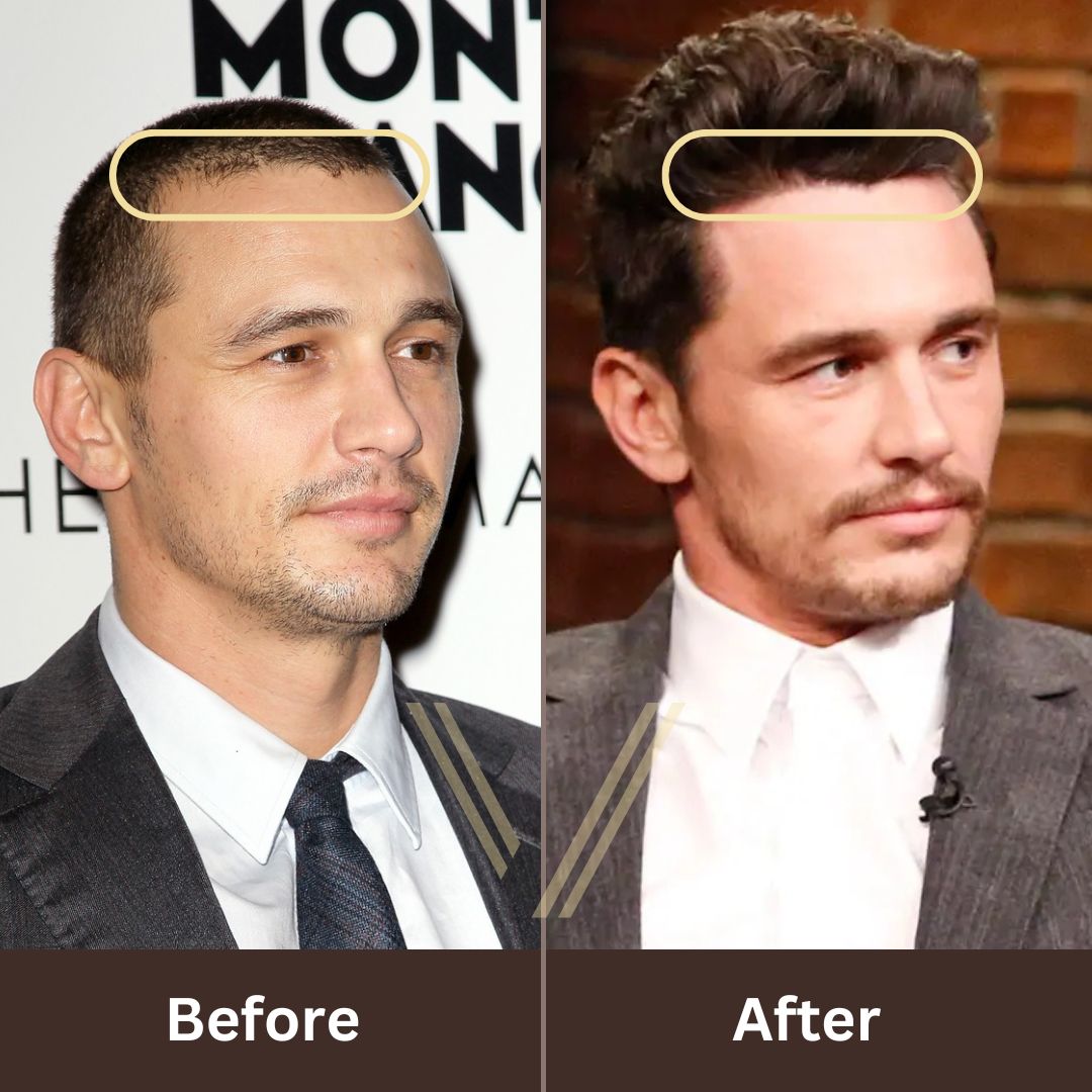 James Franco Hair Transplant - Before and After