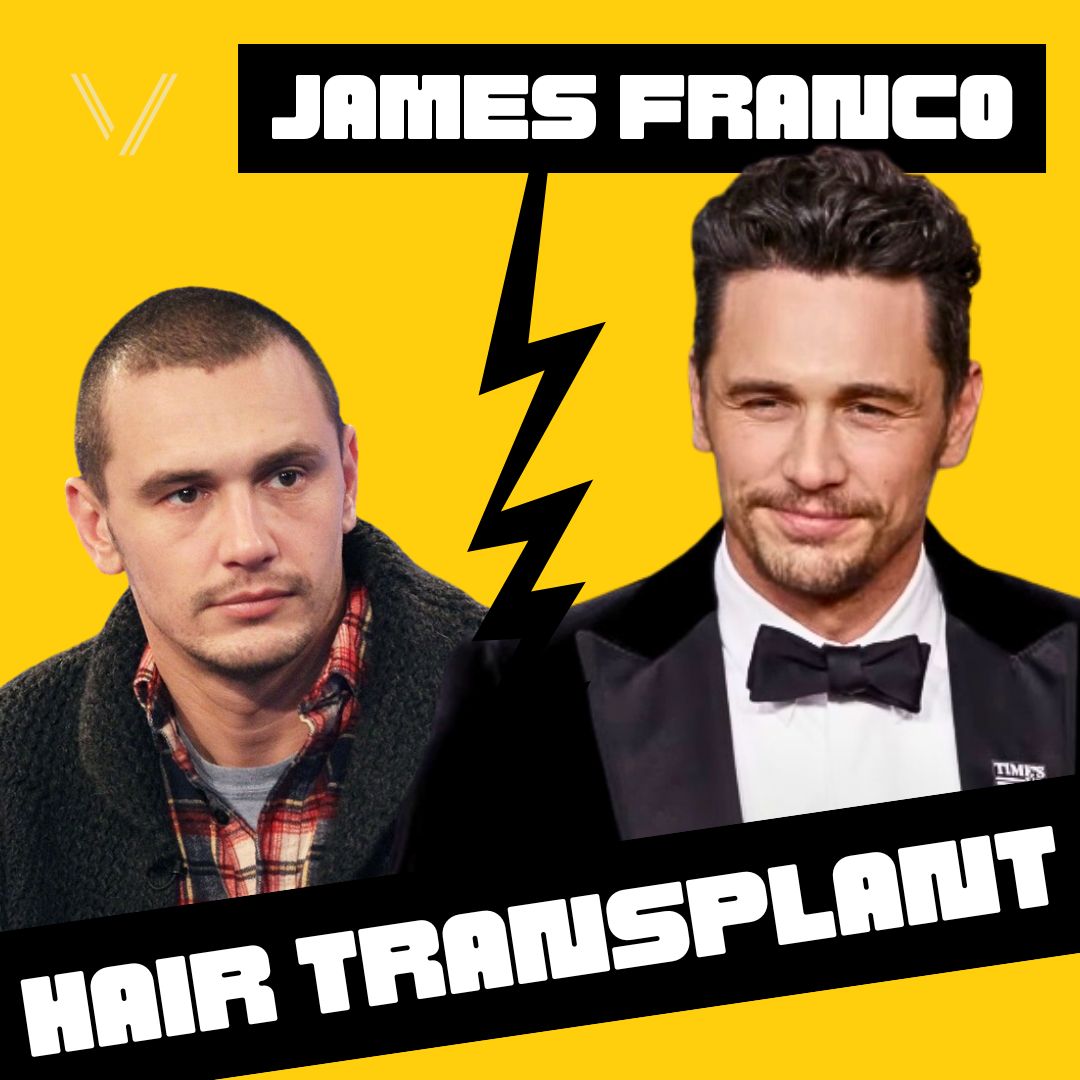 James Franco Hair Transplant - Before and After