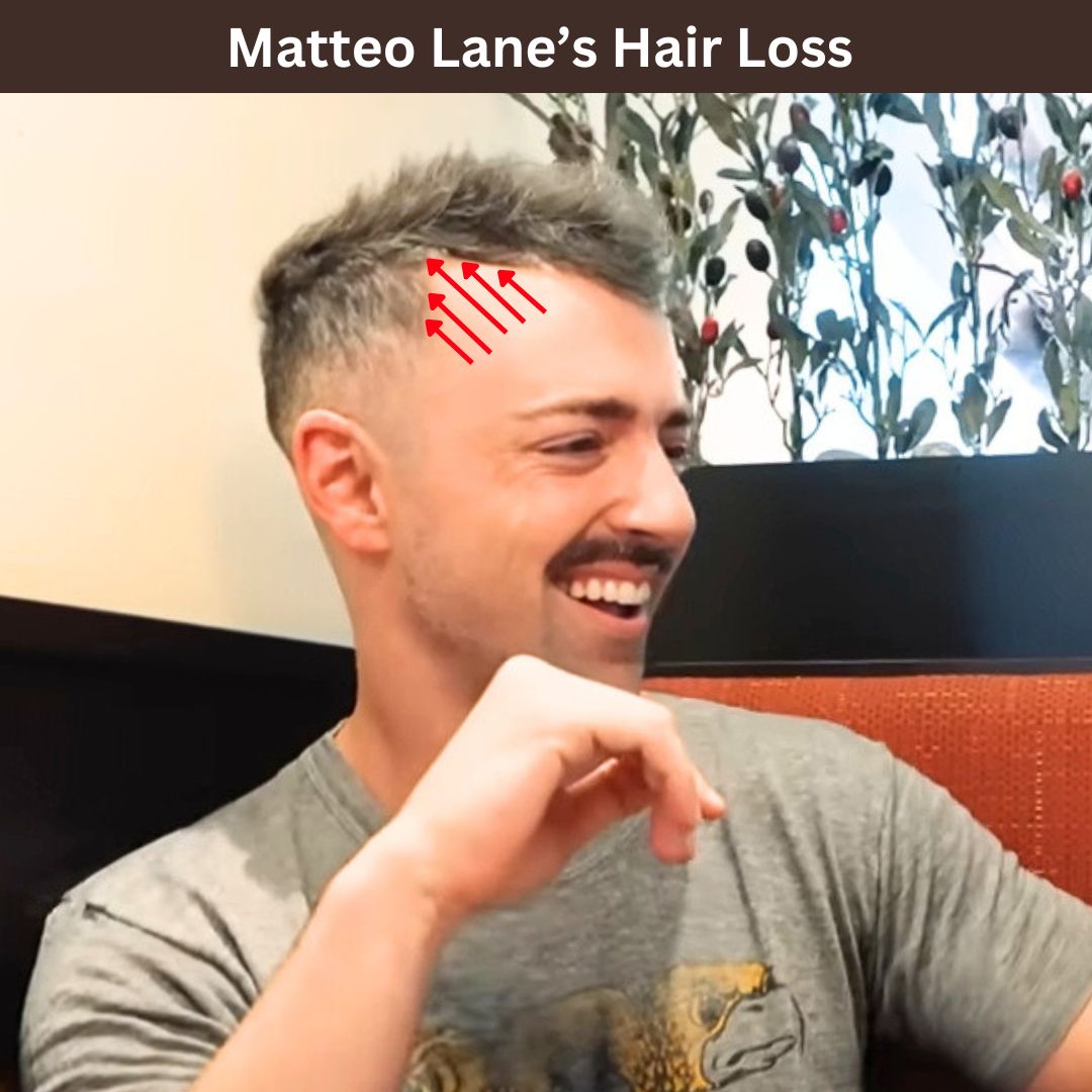 Matteo Lane Hair Transplant - Before and After