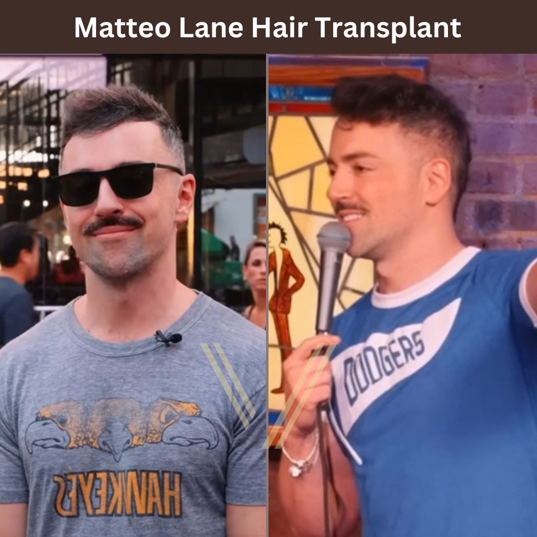Matteo Lane Hair Transplant - Before and After